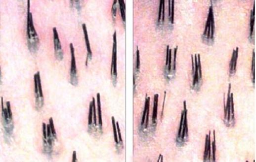 Two Hairs One Follicle On Scalp Pubic Area Legs Hair Mag